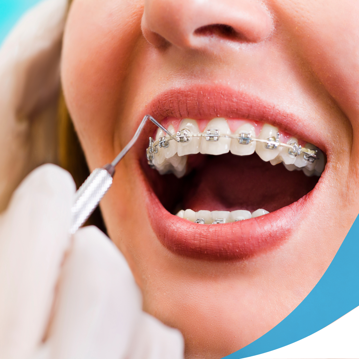The Different Types of Braces: Which Option Is Right for You - Smile ...