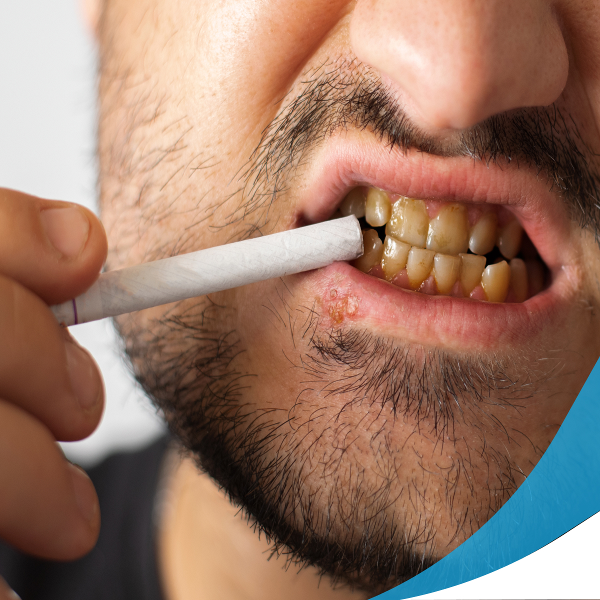 The Impact of Smoking on Oral Health: Understanding the Risks - Smile ...