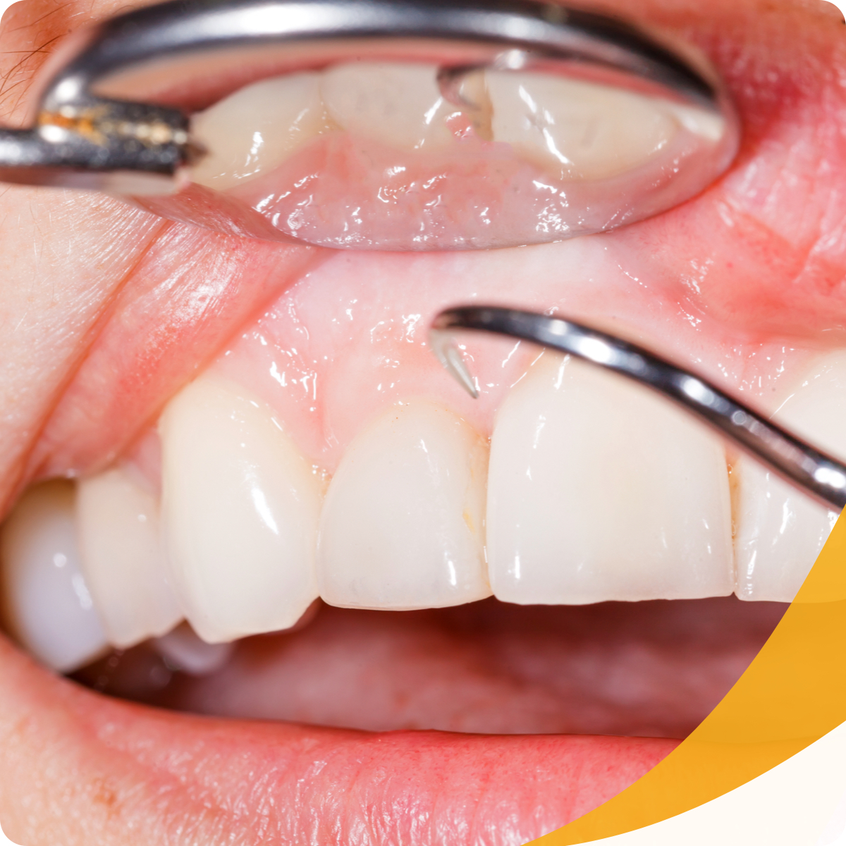 Gum Health Basics - Smile Every Day Dentistry