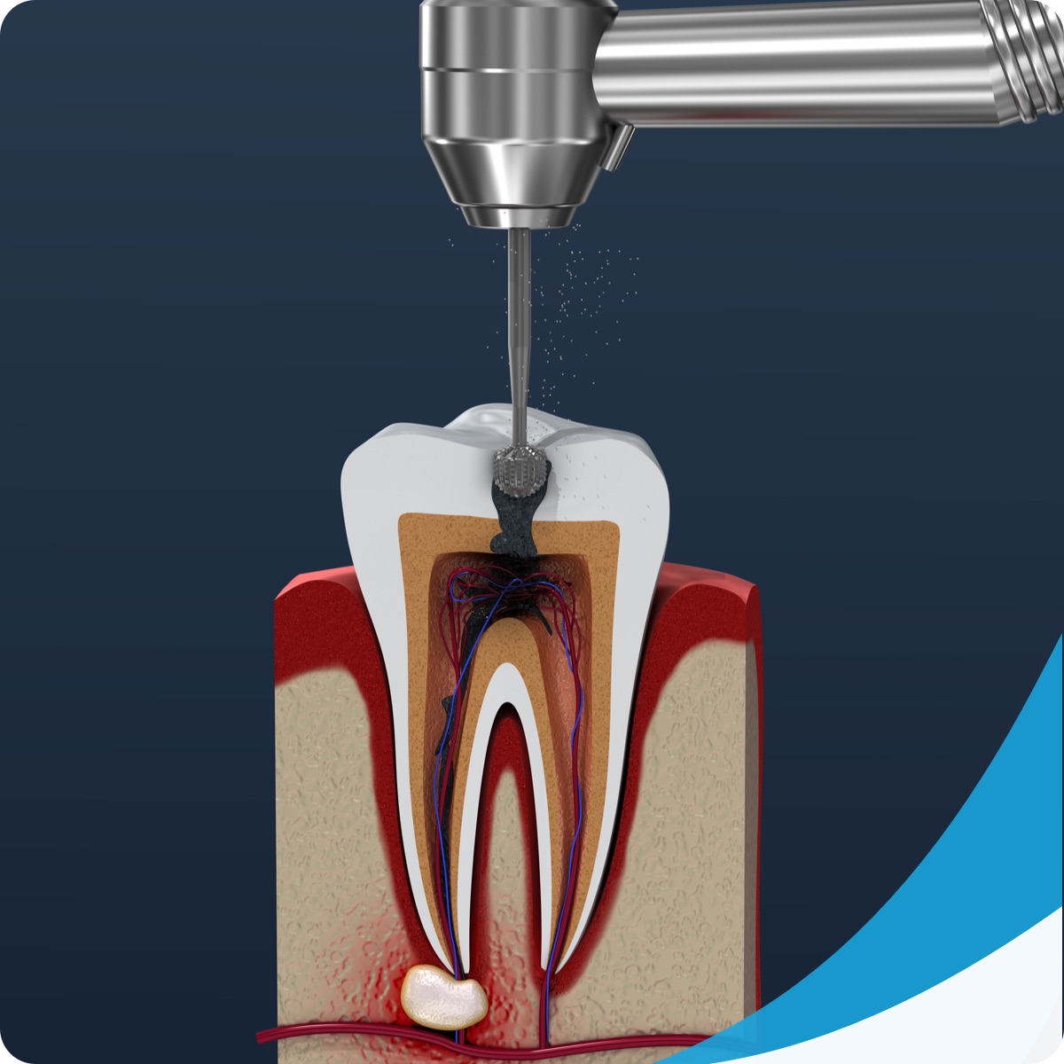 Root Canals Explained - Smile Every Day Dentistry