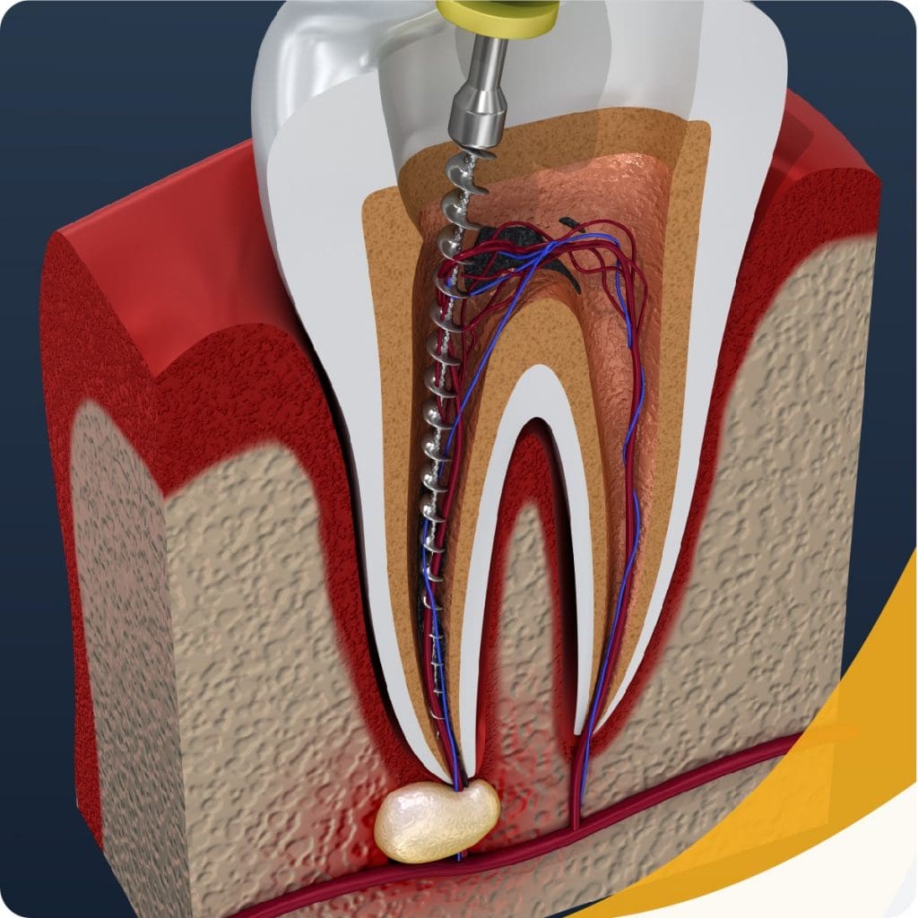 Root Canals Explained - Smile Every Day Dentistry