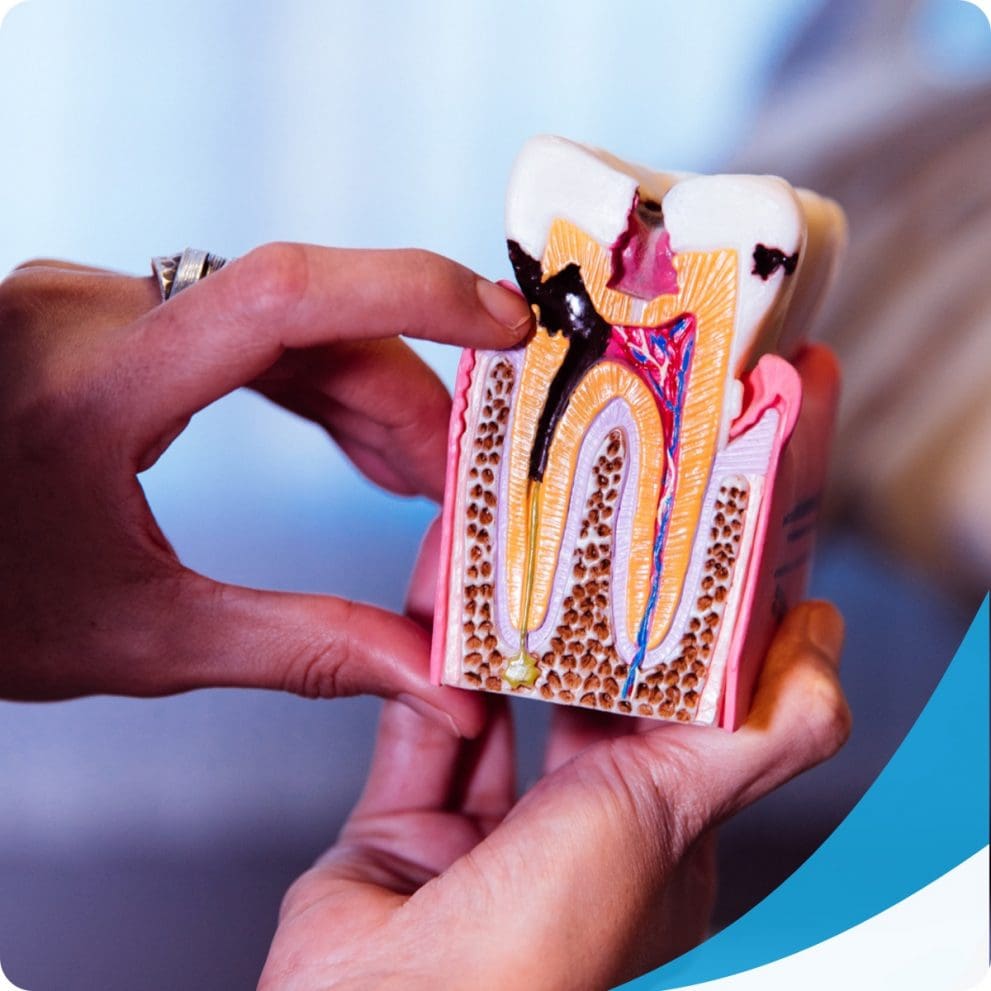 Understanding & Preventing Tooth Decay - Smile Every Day Dentistry